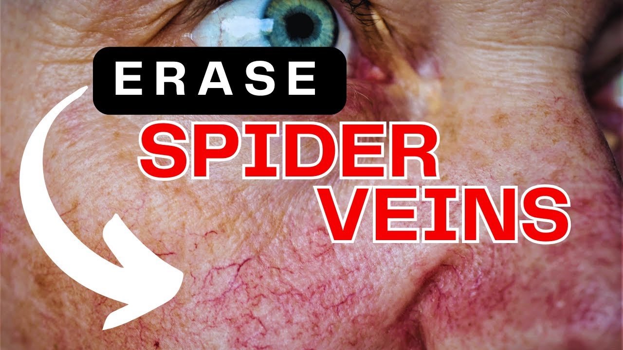 Spider Veins on Your Face? Here’s How to Treat Them Safely - YouTube