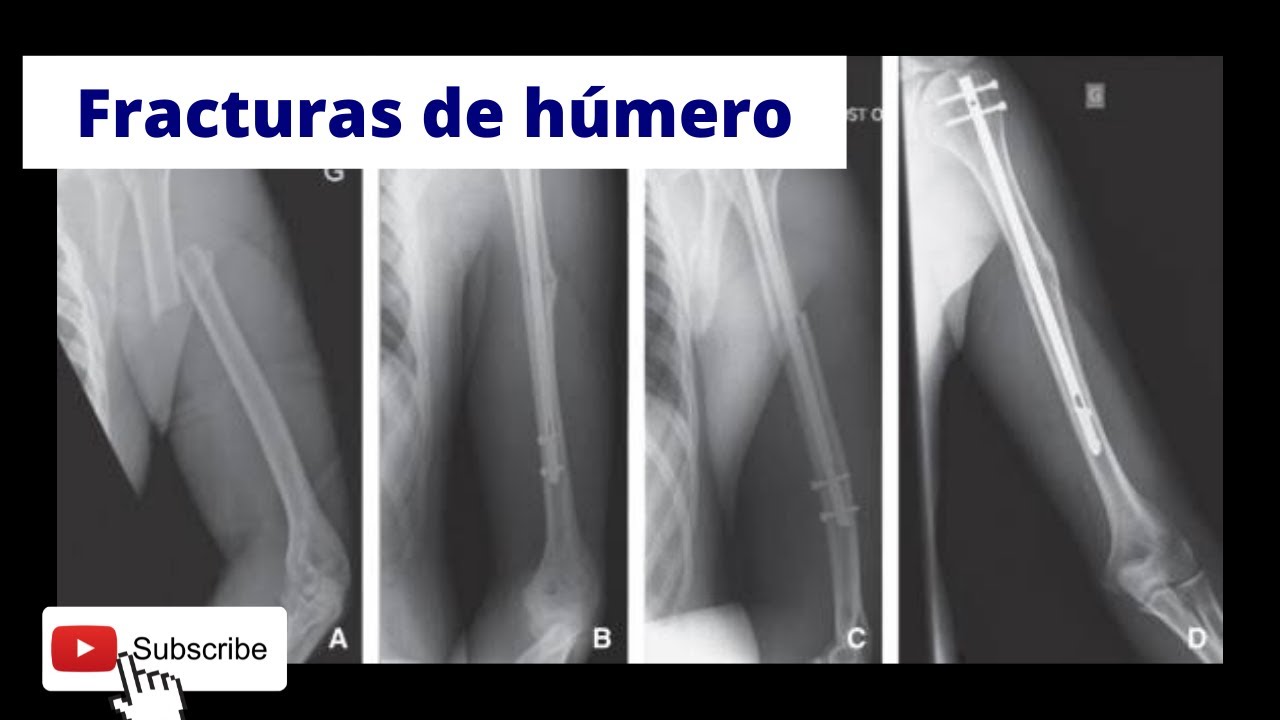 Fracturas diafisiarias de húmero - YouTube