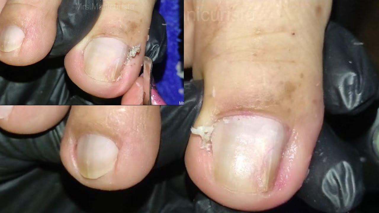 Vlog 899|Dry Skin/Ingrown Removal| PEDICURE 799 - YouTube