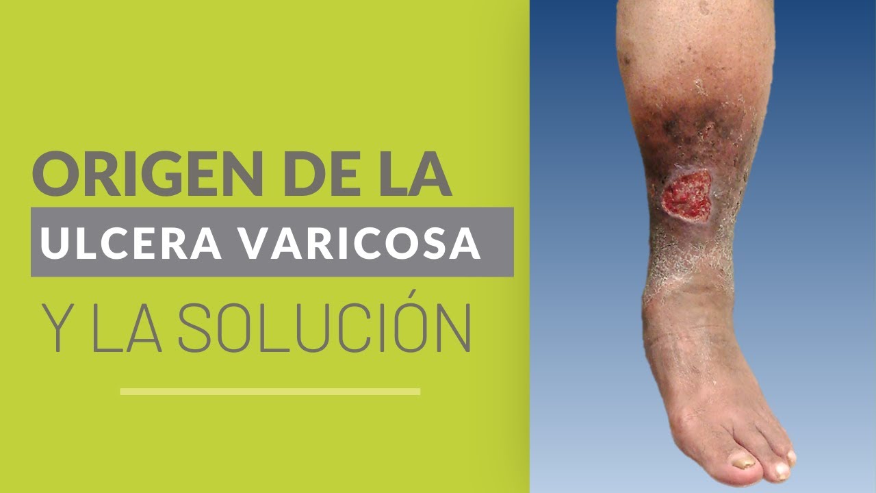 Descubre el origen de LA ULCERA VARICOSA y mira LA SOLUCIÓN. - YouTube