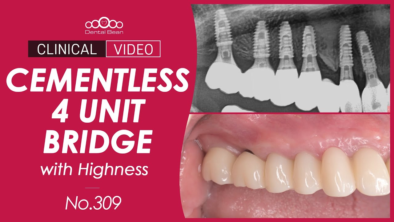 Anterior and Posterior 4 unit bridge with Highness system [Dr. Kim ...