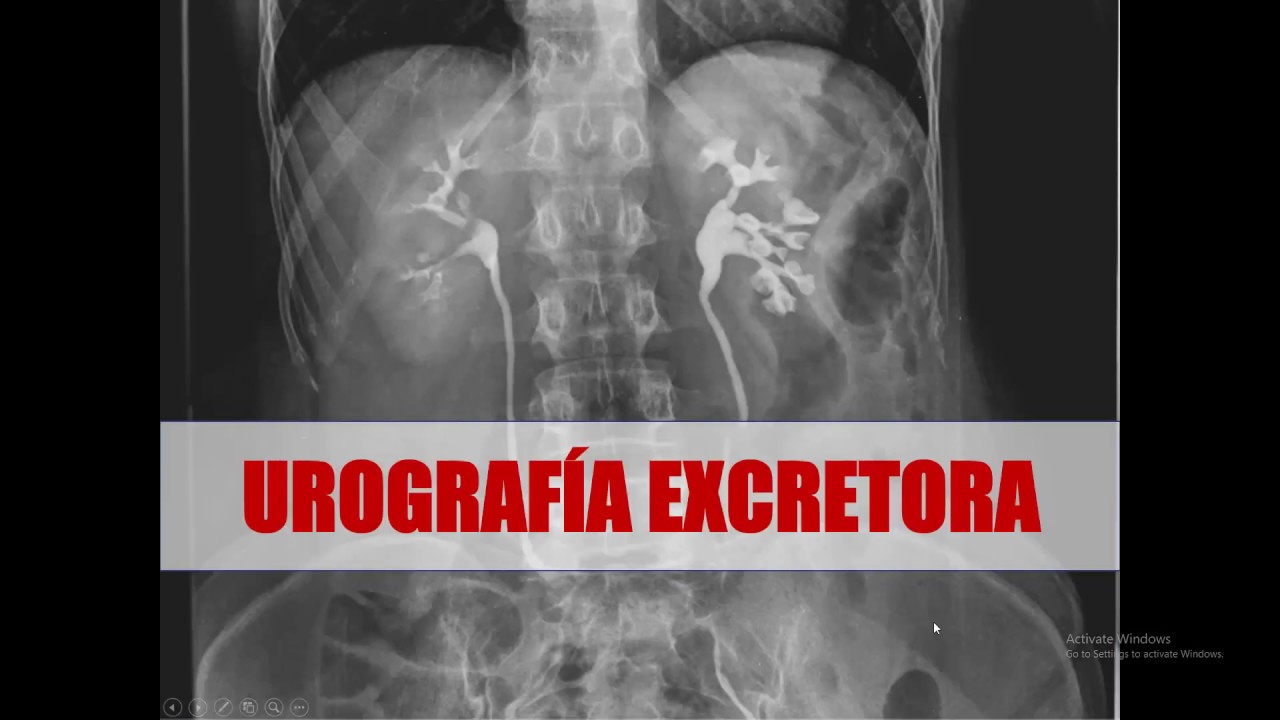 UROGRAFIA EXCRETORA (FISIOLOGIA Y REALIZACION) - YouTube