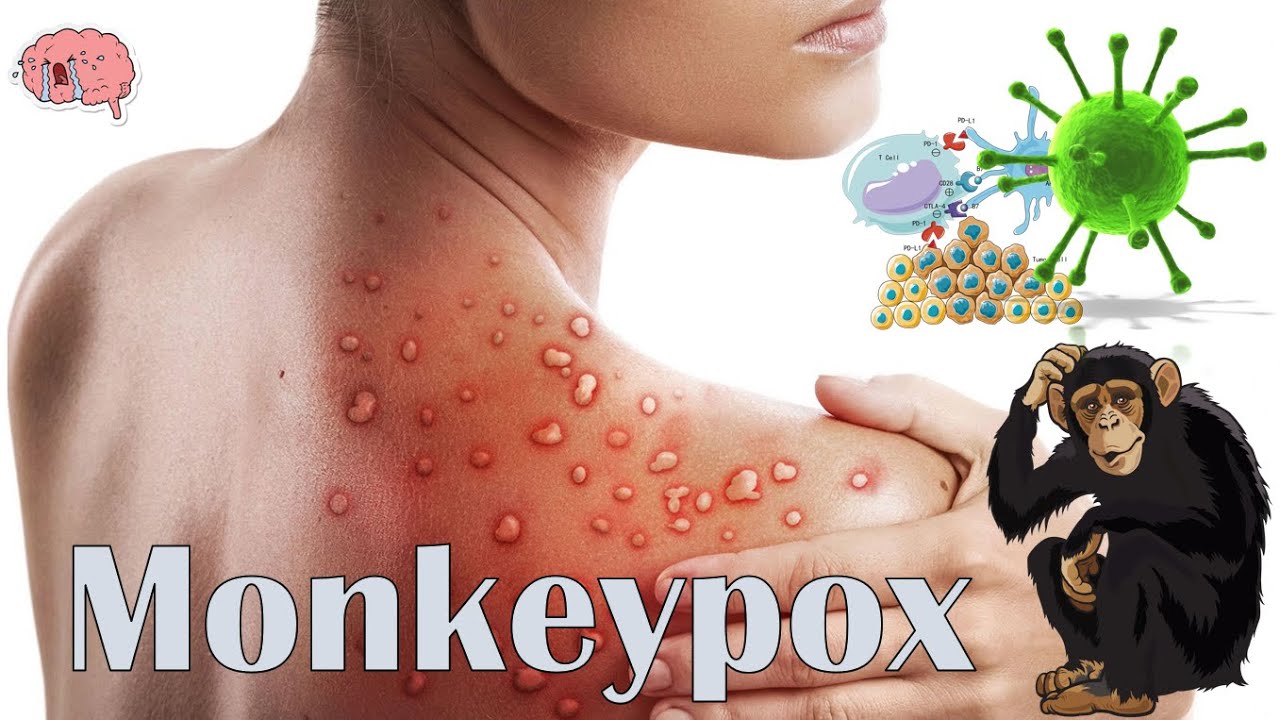 Monkeypox |The Latest Outbreak :- Everything You Need To Know - History ...