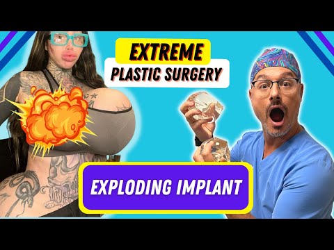 Huge Breast Implants - Extreme surgery