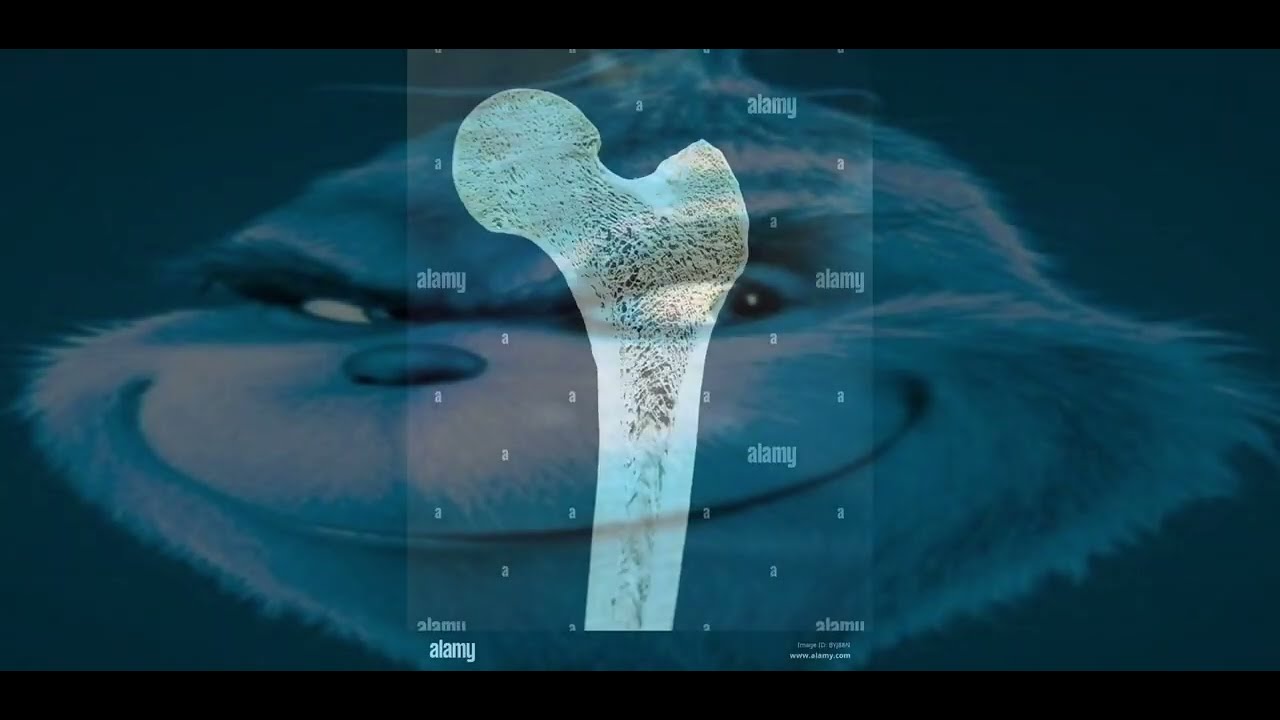 fat feeling w hen nee surge ery is two marrow - YouTube