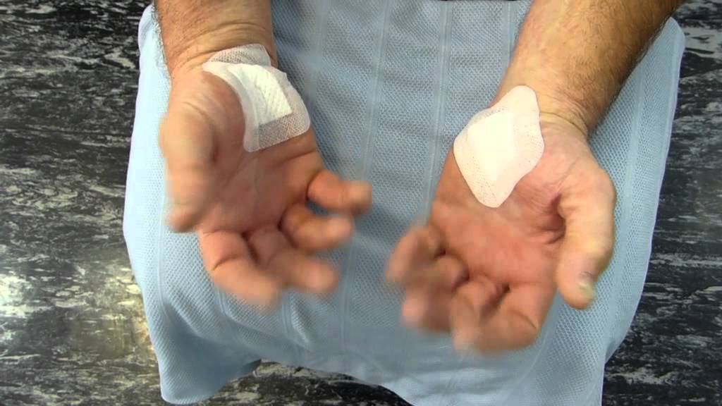 Dupuytrens or Contracted Finger surgery procedure - YouTube