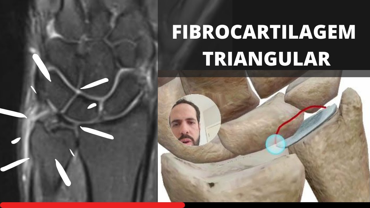 Fibrocartilagem Triangular - Tratamento - YouTube