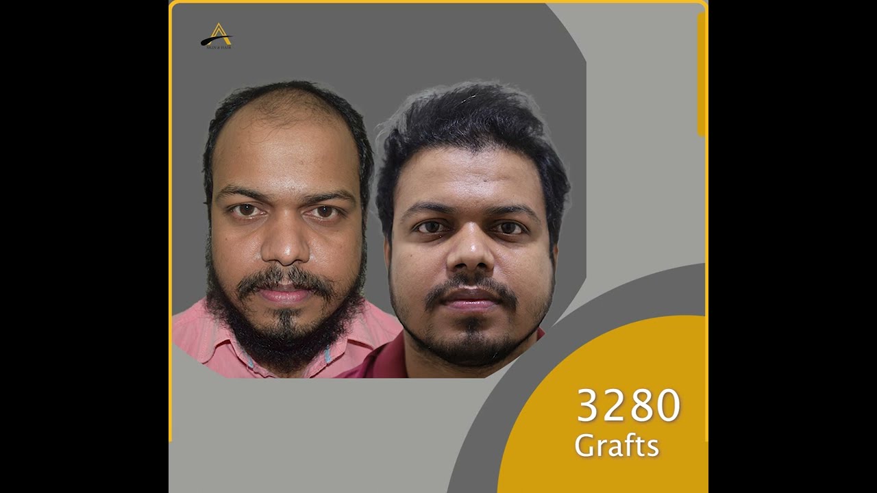 Hair Transplant Results by Dr Alok Sahoo M.D (AIIMS, New Delhi) | Book ...