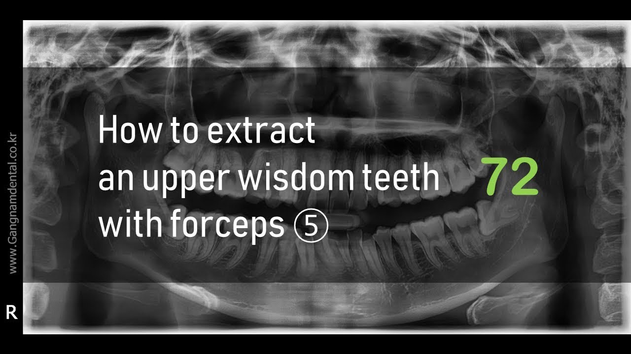 Extraction of upper wisdom tooth with forceps - YouTube