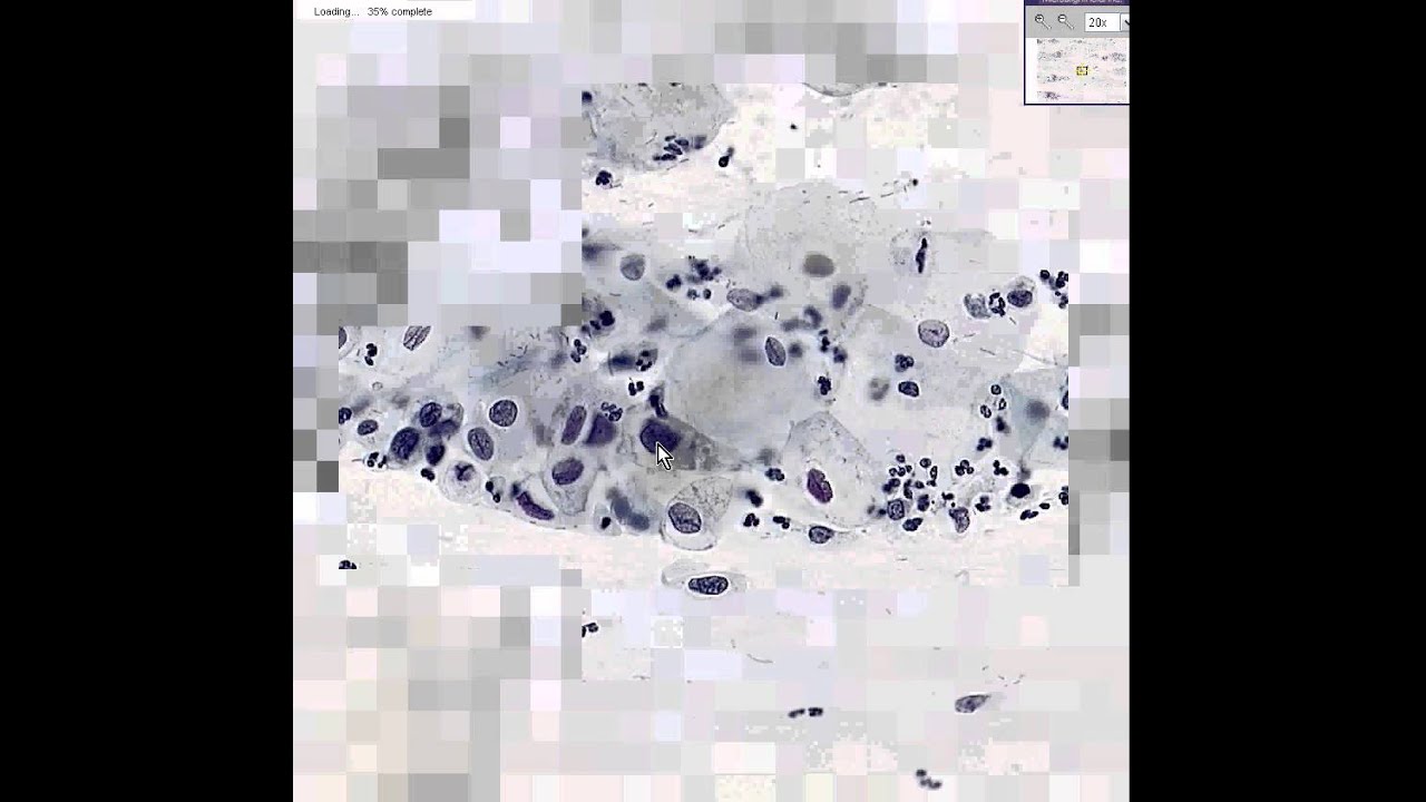 Cervix: High grade squamous intraepithelial lesion HSIL, Pap smear ...