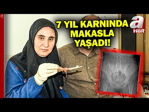 Baş ağrısı diye gitti karnında makas çıktı! 7 yıl karnında makasla yaşadı | A Haber