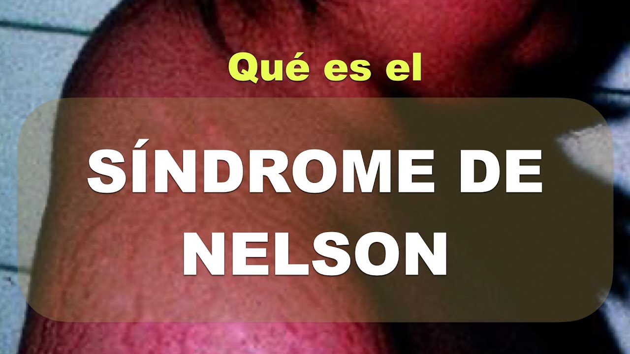 Síndrome de Nelson. Qué es. Síntomas y Tratamiento. - YouTube