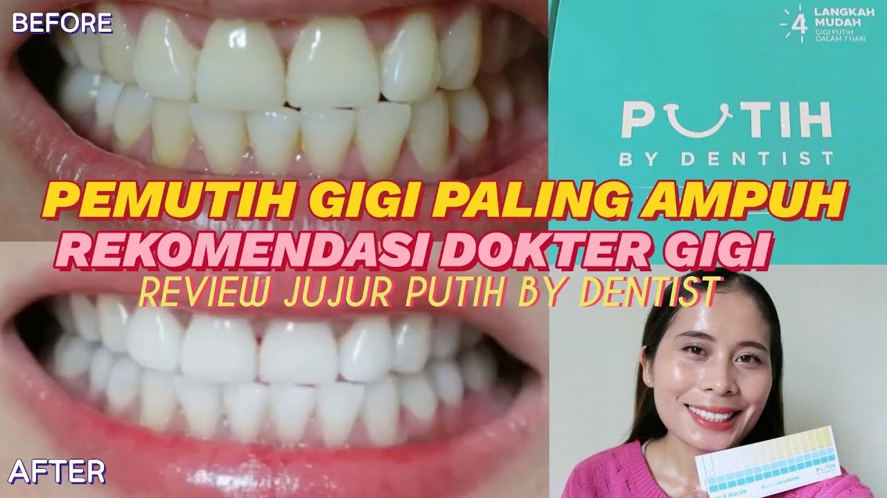 PEMUTIH GIGI DENGAN CEPAT PAKAI PUTIH BY DENTIST -REVIEW PUTIH BY ...