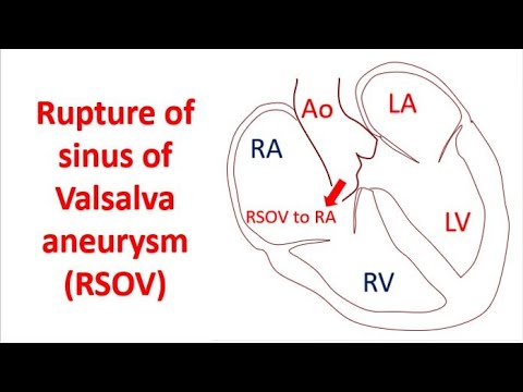 Rupture of sinus of Valsalva aneurysm (RSOV) - YouTube