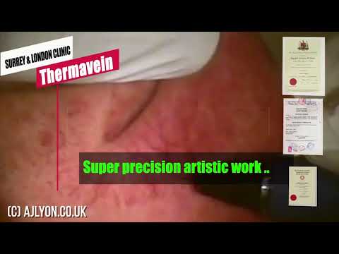 THERMAVEIN for treating annoying spider veins ... efficient, safe, and rapid
