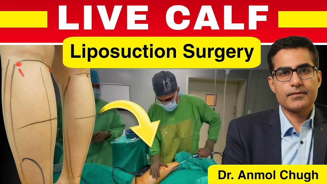 LIVE Calf Liposuction Surgical Video: Sculpted Legs with Ultrasonic ...
