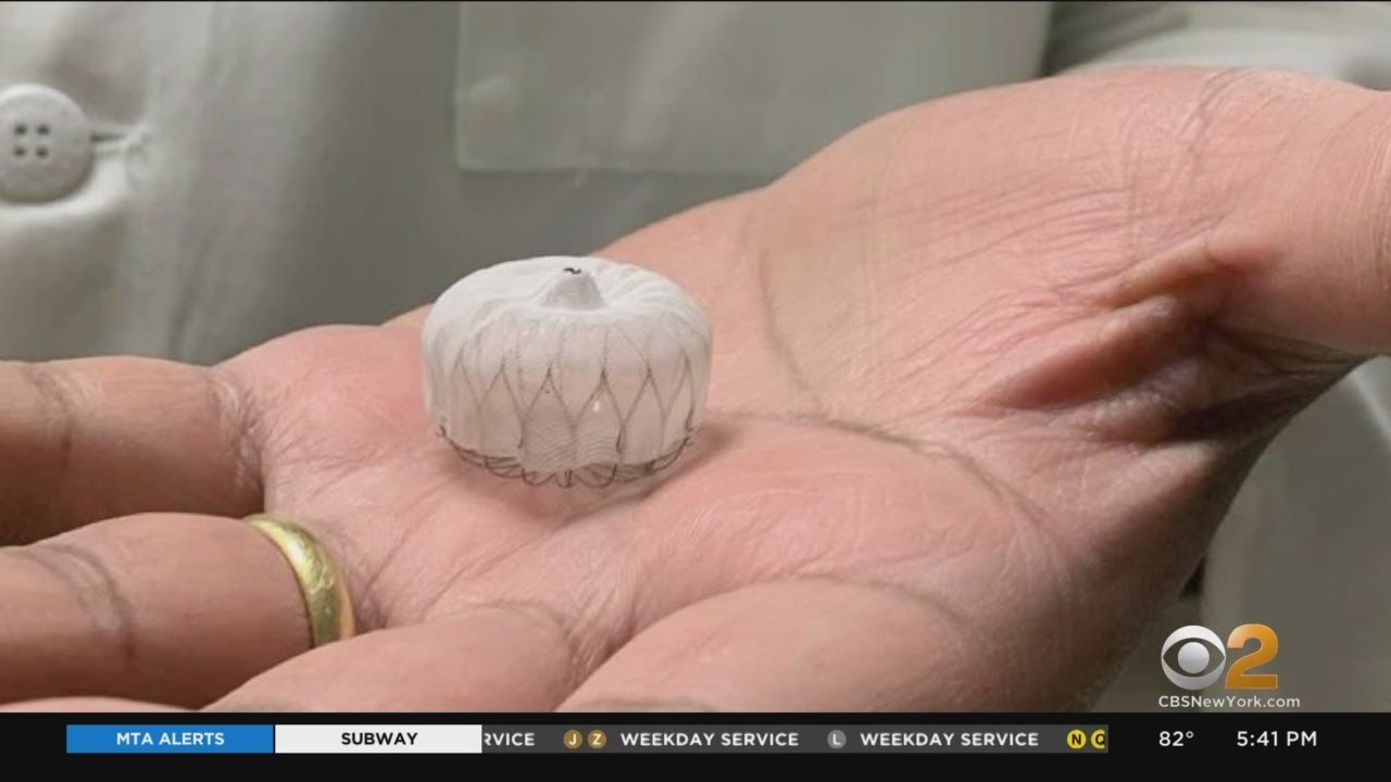 Implantable Device Helps Prevent Strokes - YouTube