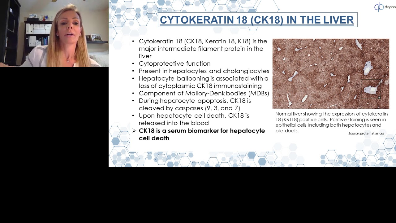 CK18 as a Biomarker in NASH Clinical Trials - YouTube