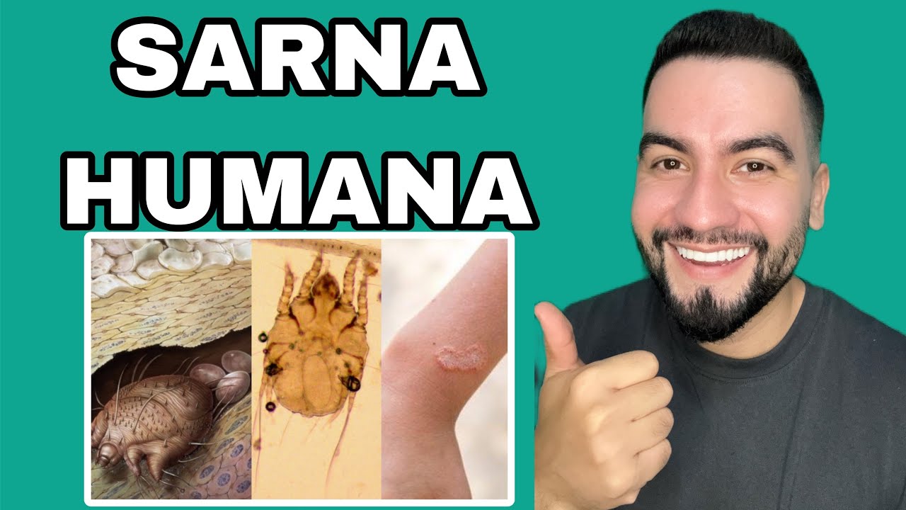 ESTO ES SARNA HUMANA Y ASÍ PUEDES TRATARLA | DR. DAVID CAMPOS - YouTube