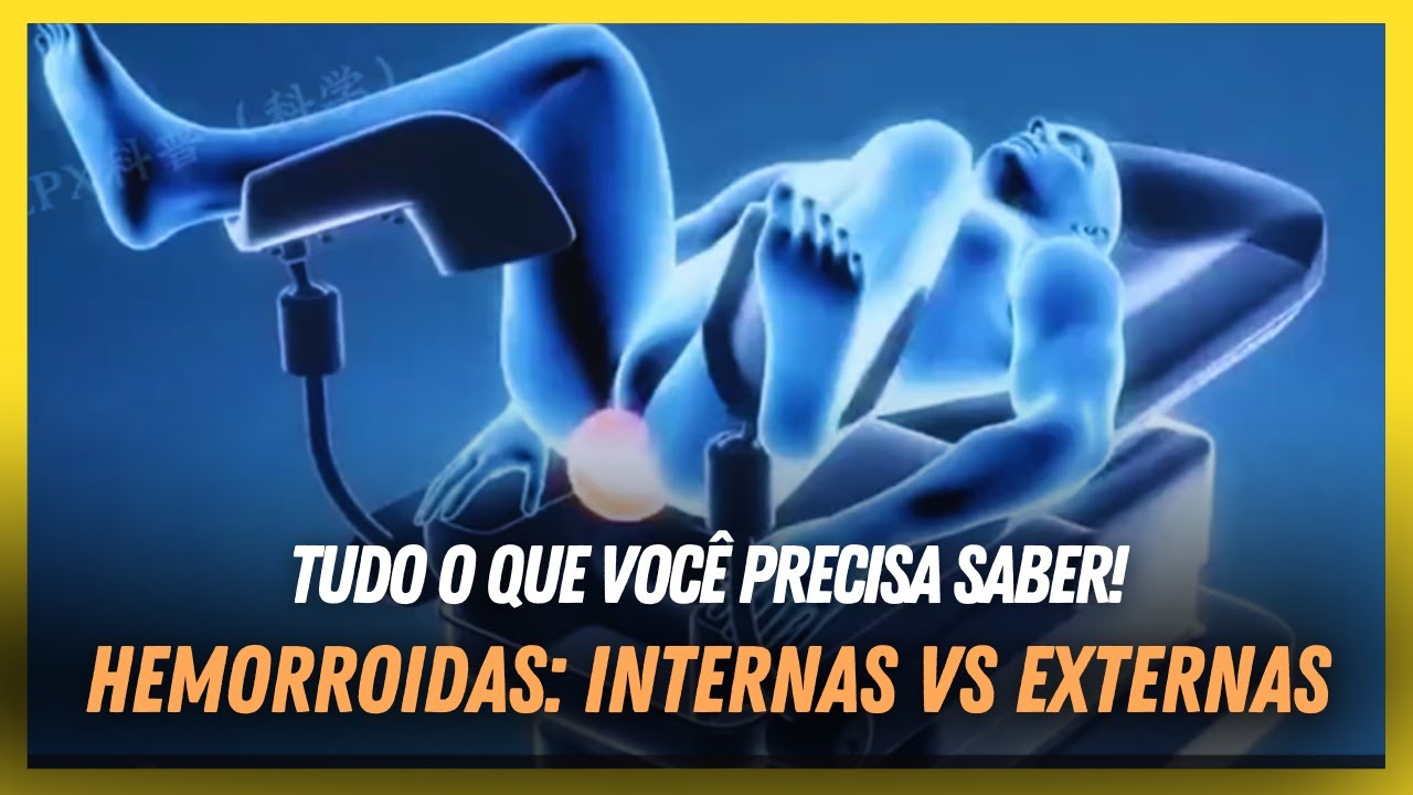 Descubra Como Suas Hemorroidas se Formam e as Diferenças Entre ...