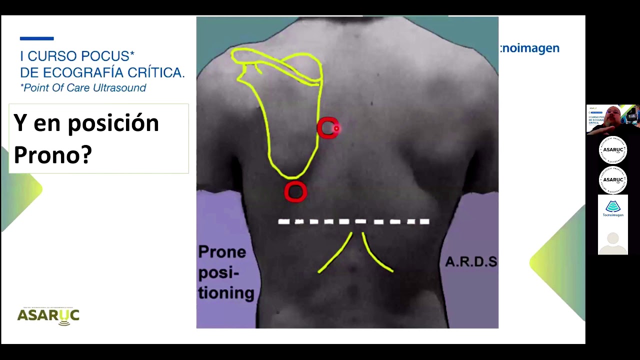 Ecografia Pulmonar en el POCUS - YouTube