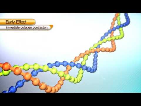 IntraGen Animation Radio Frequency Energy Treatment - YouTube