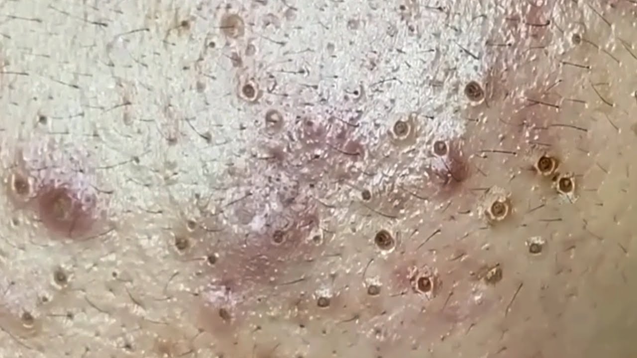 Satisfying Acne and Pimple Removal Blackheads & Whiteheads #1430 - YouTube