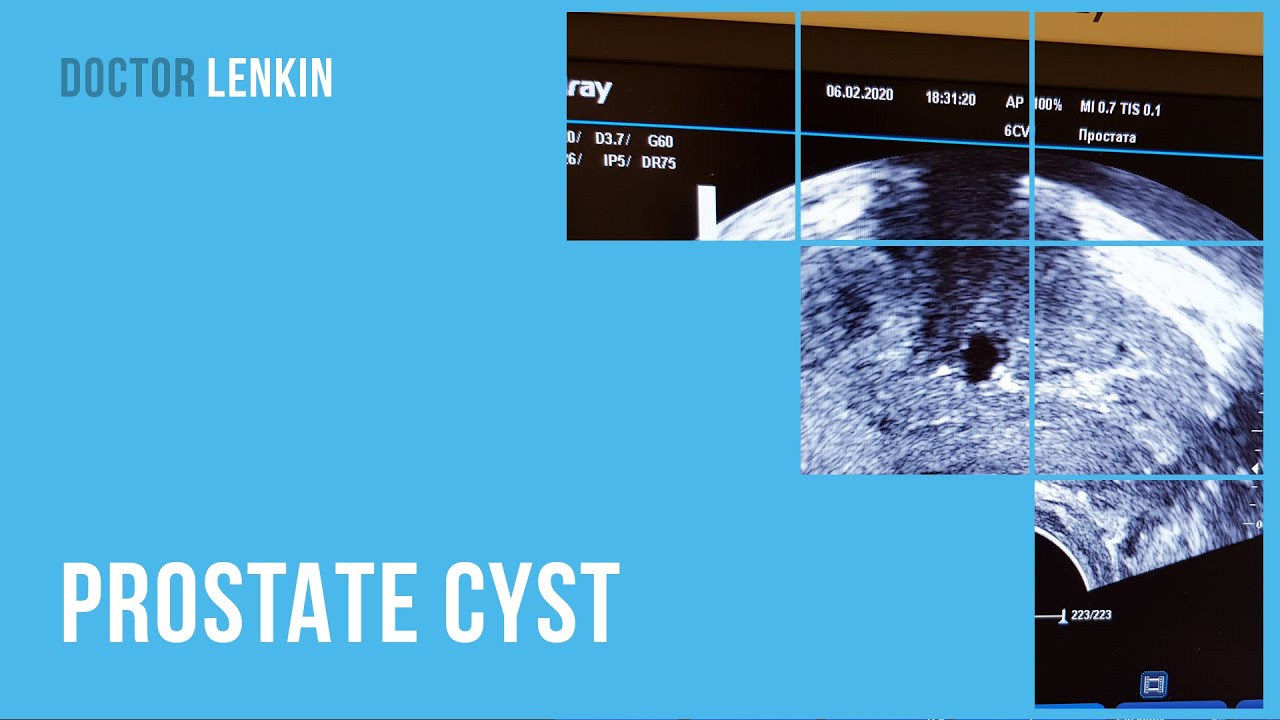 😲 Prostate cyst - YouTube