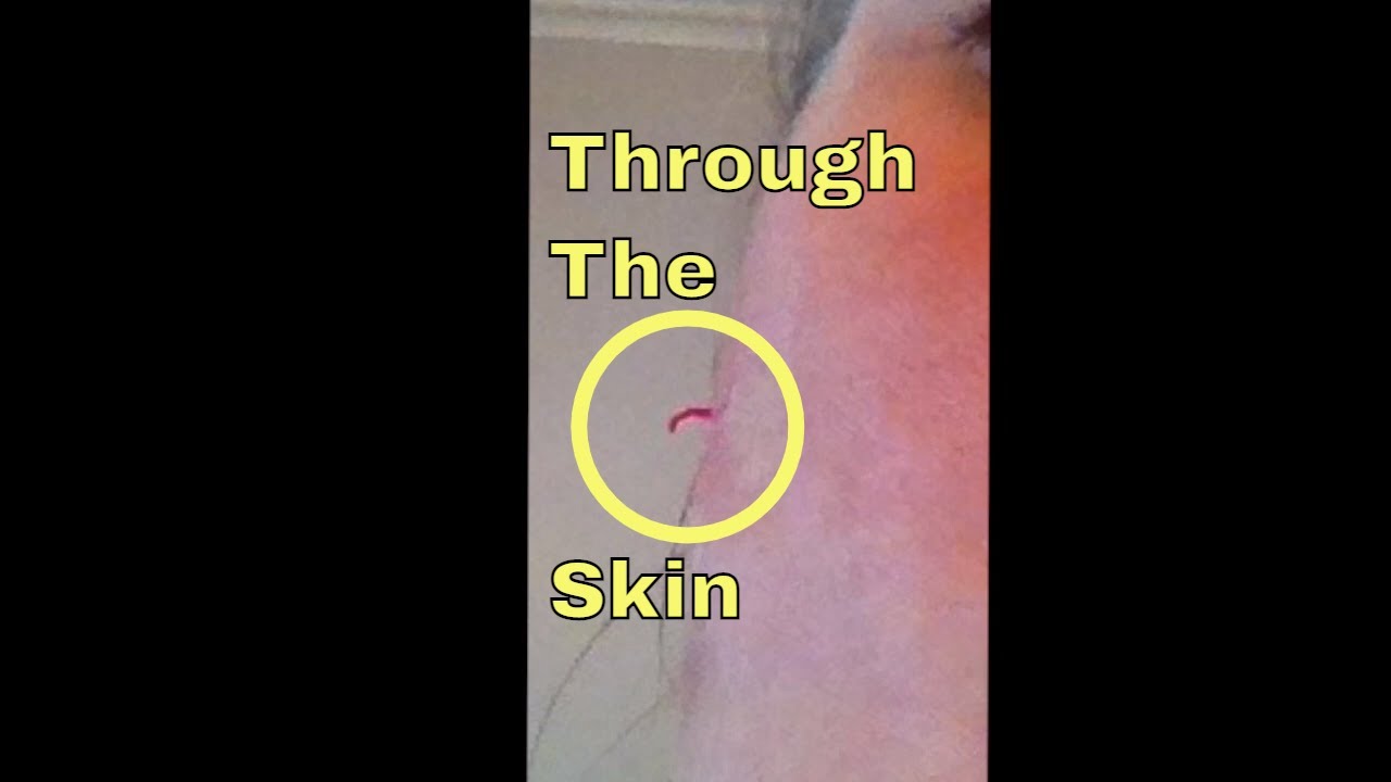 Discharging A Blood Fluke Through The Skin - YouTube