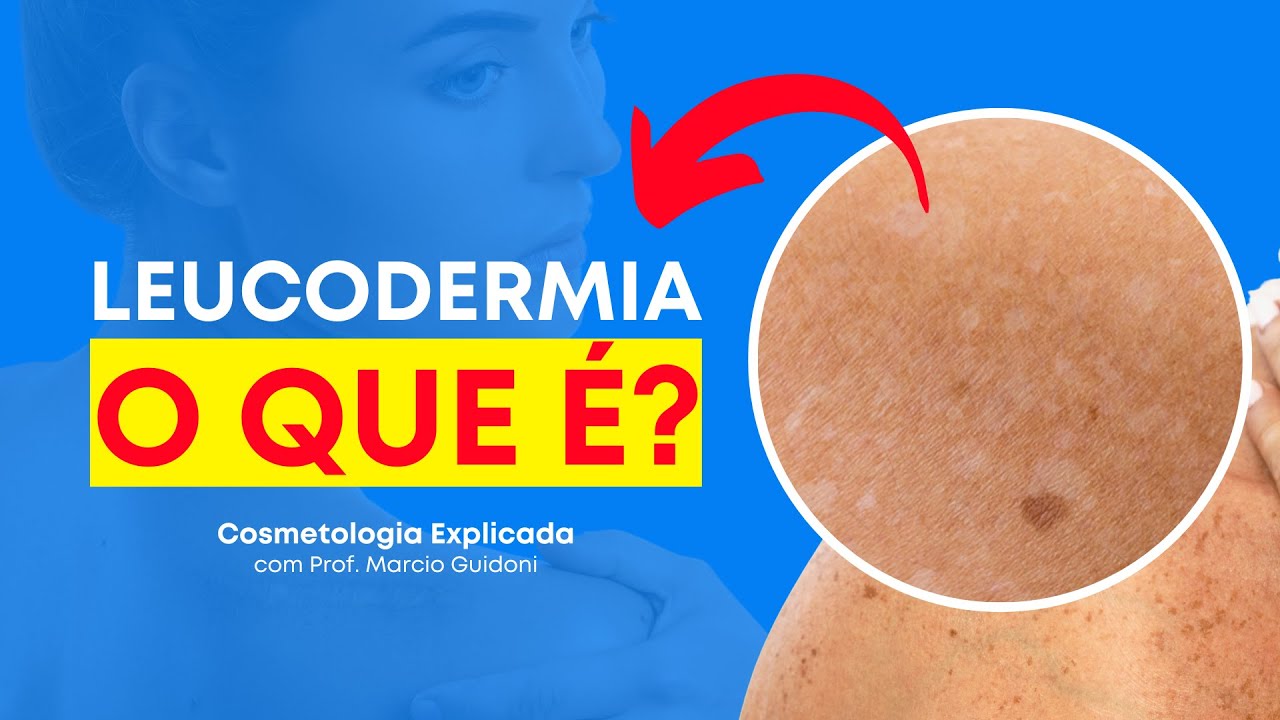 O QUE SÃO LEUCODERMIAS | Cosmetologia Explicada com Prof. Marcio ...