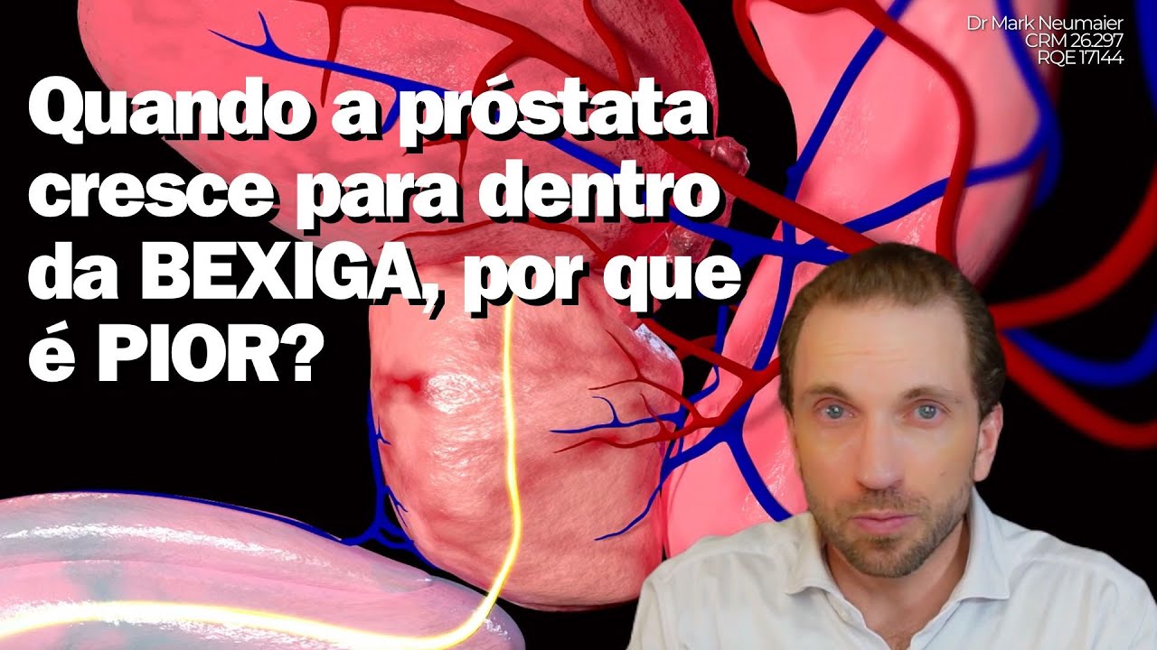 Quando a próstata cresce para dentro da bexiga - LOBO MEDIANO - é mais ...