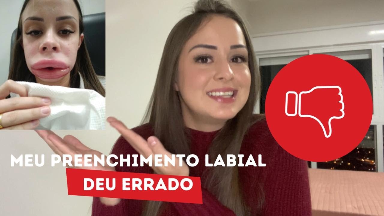Meu Preenchimento Labial Deu Errado Youtube
