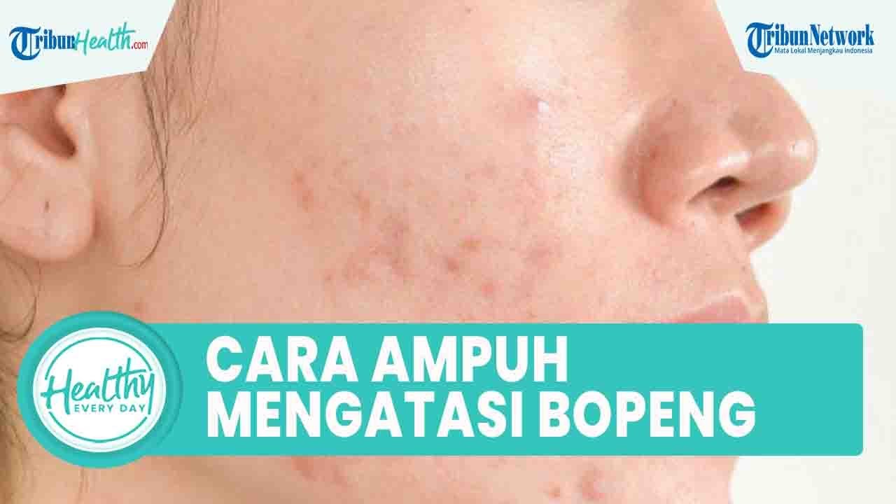 Cara Ampuh Atasi Bopeng di Kulit Wajah akibat Jerawat hanya di Rumah ...