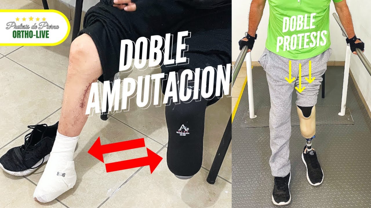 Amputacion Transtibial y parcial de pie - YouTube