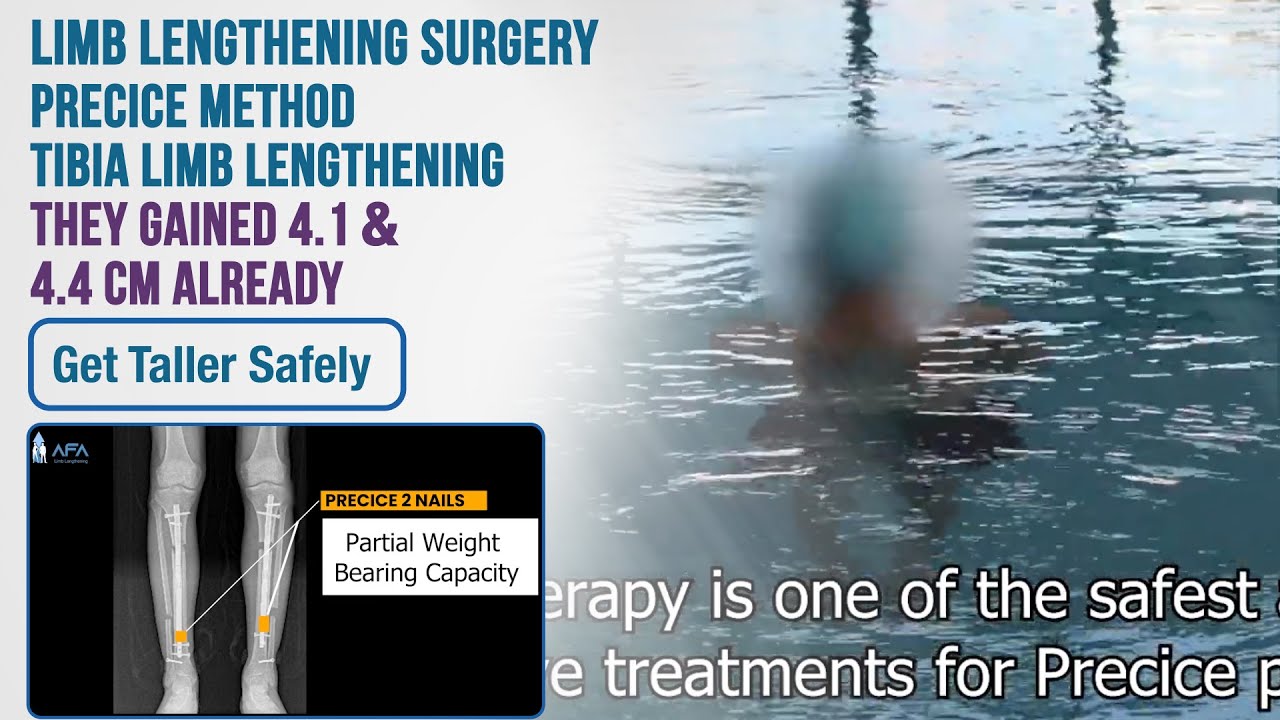 Precice 2 Tibia Limb Lengthening / They Gained 4.1 & 4.4 cm already ...