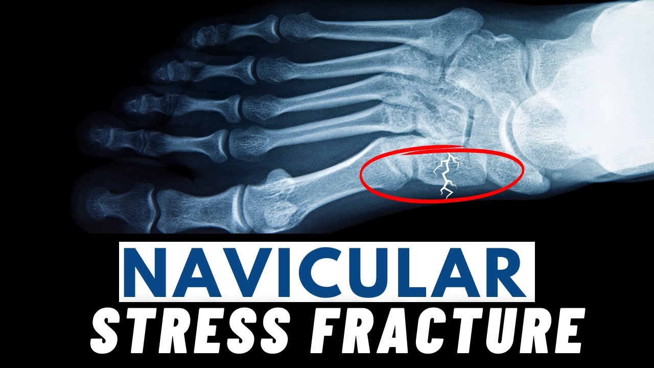 Navicular Stress Fractures | Symptoms, Causes, Diagnosis & Treatment ...