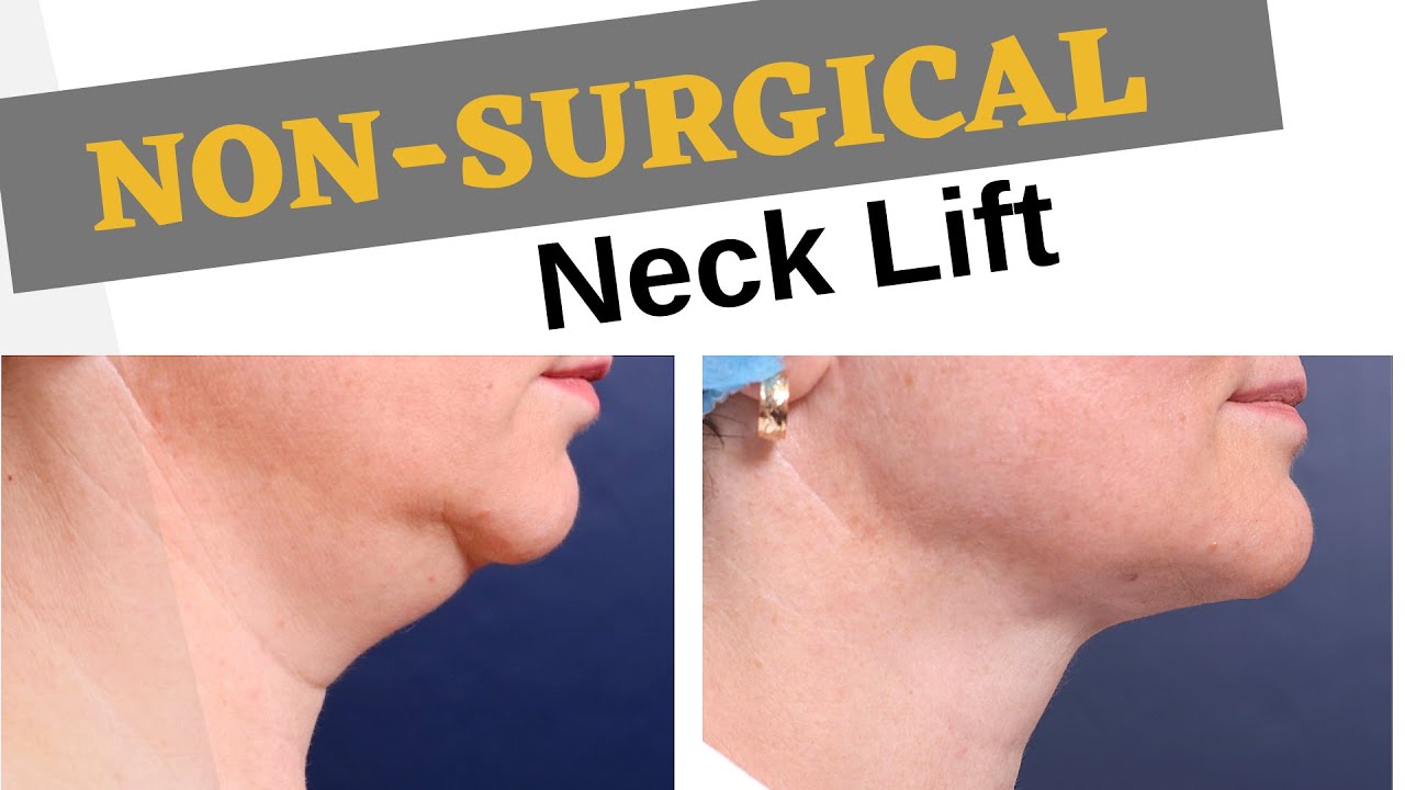 Non-Surgical Neck Lift | Permanent Results of Skin Secrets by Dr ...