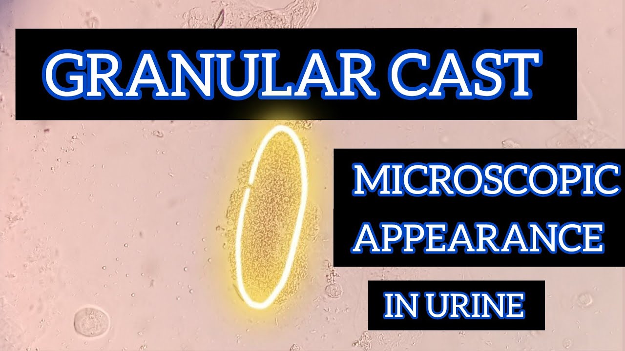 Granular Cast In Urine Microscopic Appearance Short Video Pathologymaster7044 Youtube