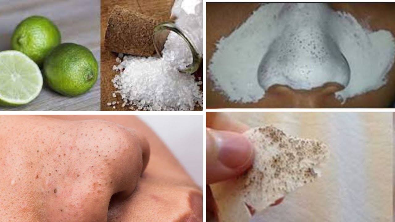 Como remover CRAVOS do rosto de forma natural - YouTube