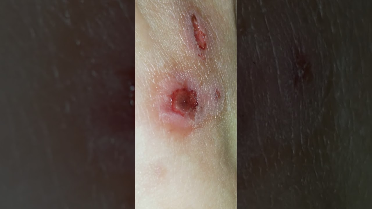 Meth mites or parasites?? - YouTube