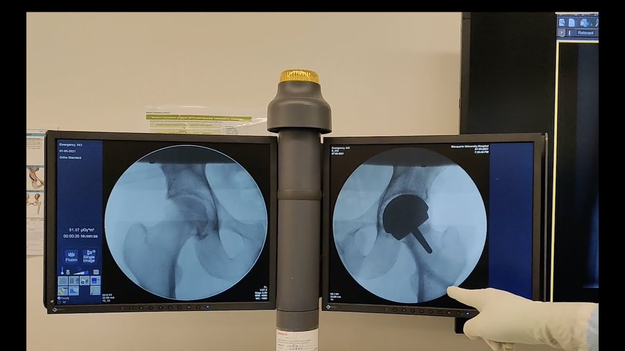 Hip Resurfacing Via Direct Anterior Approach(DAA) - YouTube