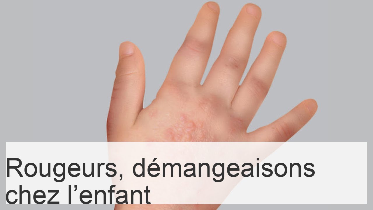 Rougeurs, démangeaisons chez l'enfant : causes et traitement - YouTube