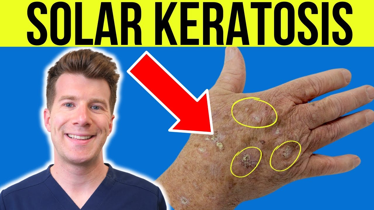 Doctor explains Actinic Solar Keratosis | Sun damaged skin - causes, symptoms and treatment ...