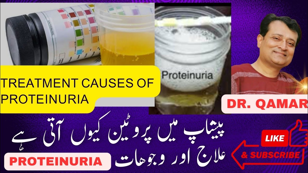Causes Treatment of proteinuria |Dr Qamar - YouTube