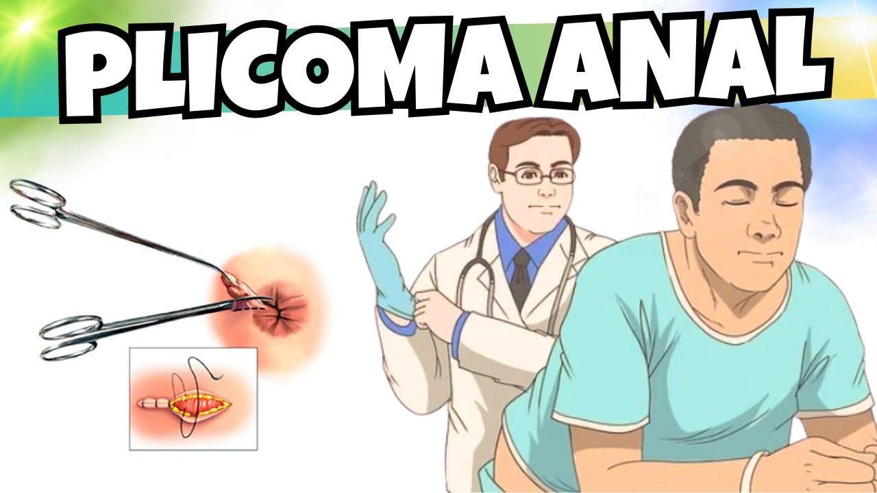 O Que É Plicoma Anal? Saiba Tudo neste vídeo - YouTube