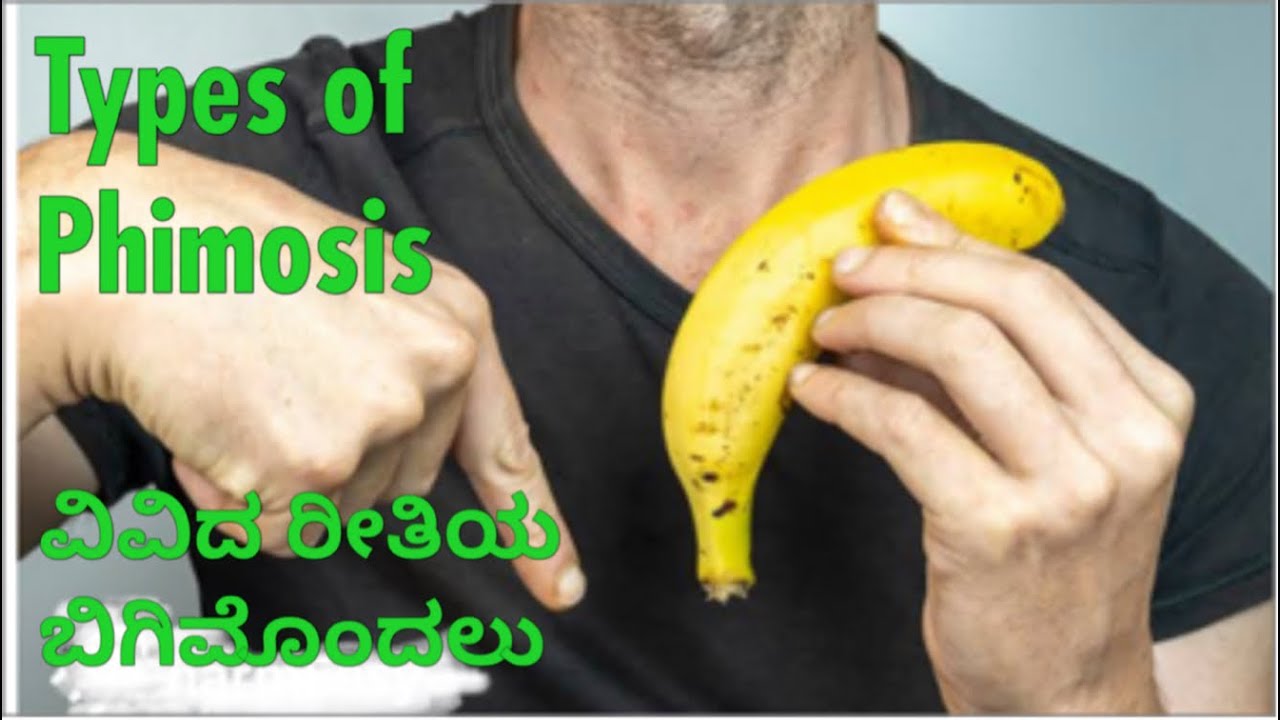 Types of Phimosis, ವಿವಿದ ರೀತಿಯ ಬಿಗಿ ಮುಂದೊಗುಲು, ಮುಂಜಿ. Circumcision, Dr ...