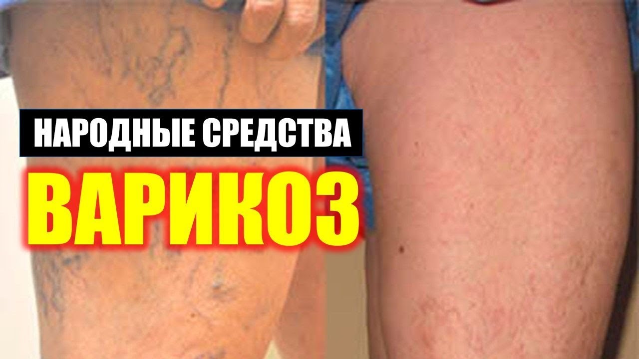 Лечение от Варикоза Народные Средства. Лечение и Профилактика Варикоза ...