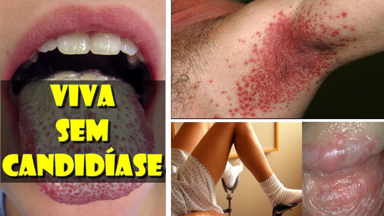 Sintomas Da Candidíase Masculina - FDPLEARN