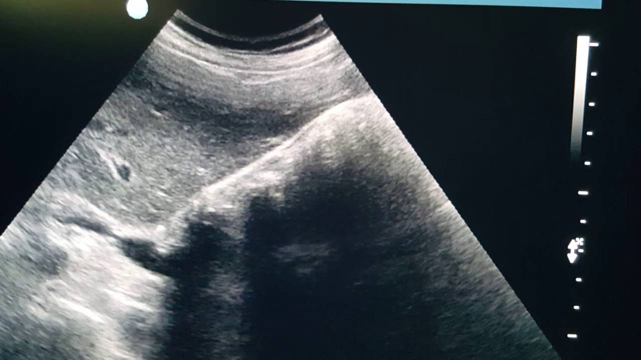 GB ultrasound - YouTube