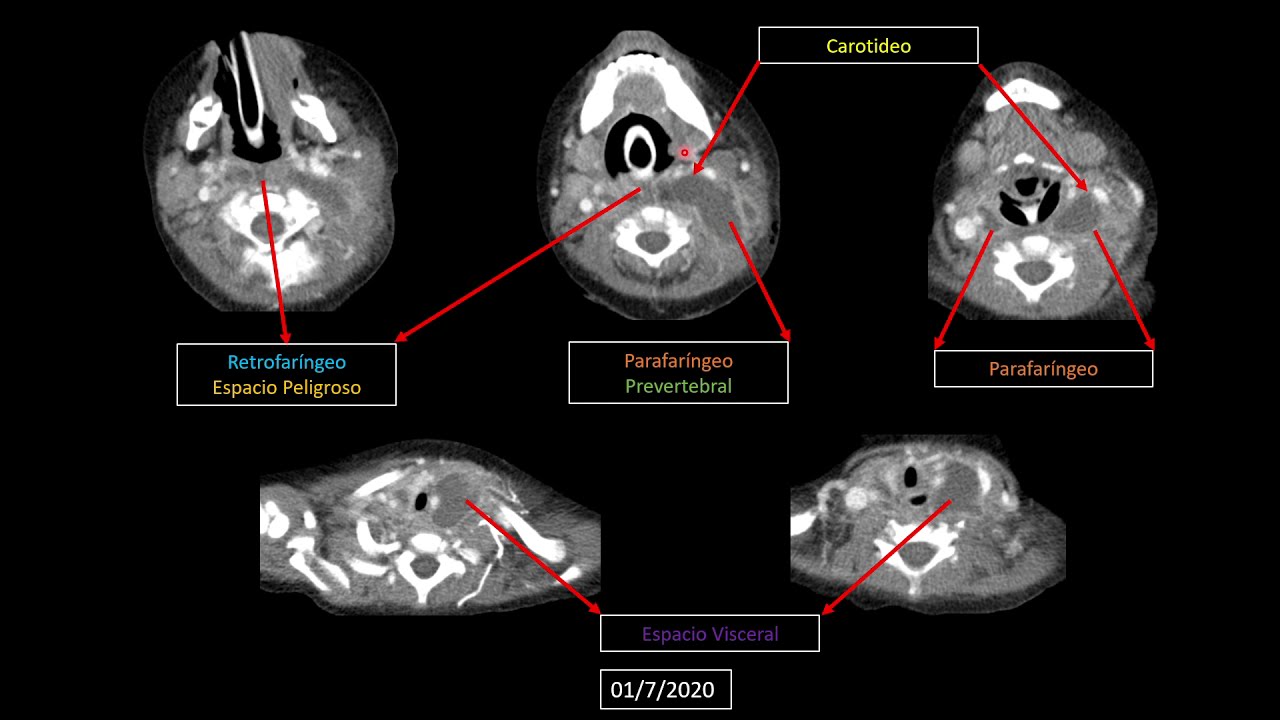 Caso del Mes n°42 Marzo 2021, "Absceso Retrofaringeo con Mediastinitis ...